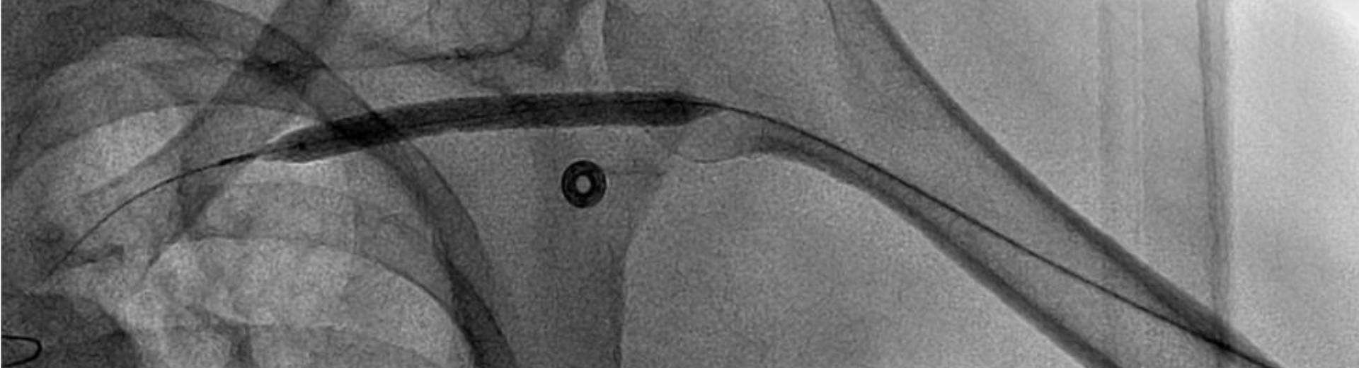 Intervential Radiology | Summa Health