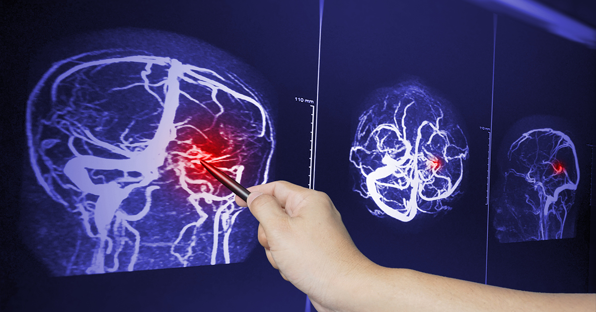 Traumatic Brain Injuries: What You Need to Know